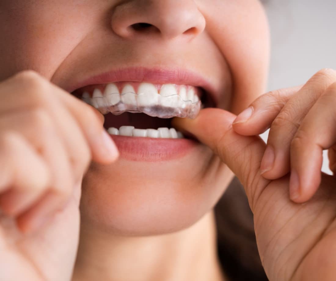 Custom Soft Night Guard for Snoring Clenching Grinding Sleep Apnea and ...