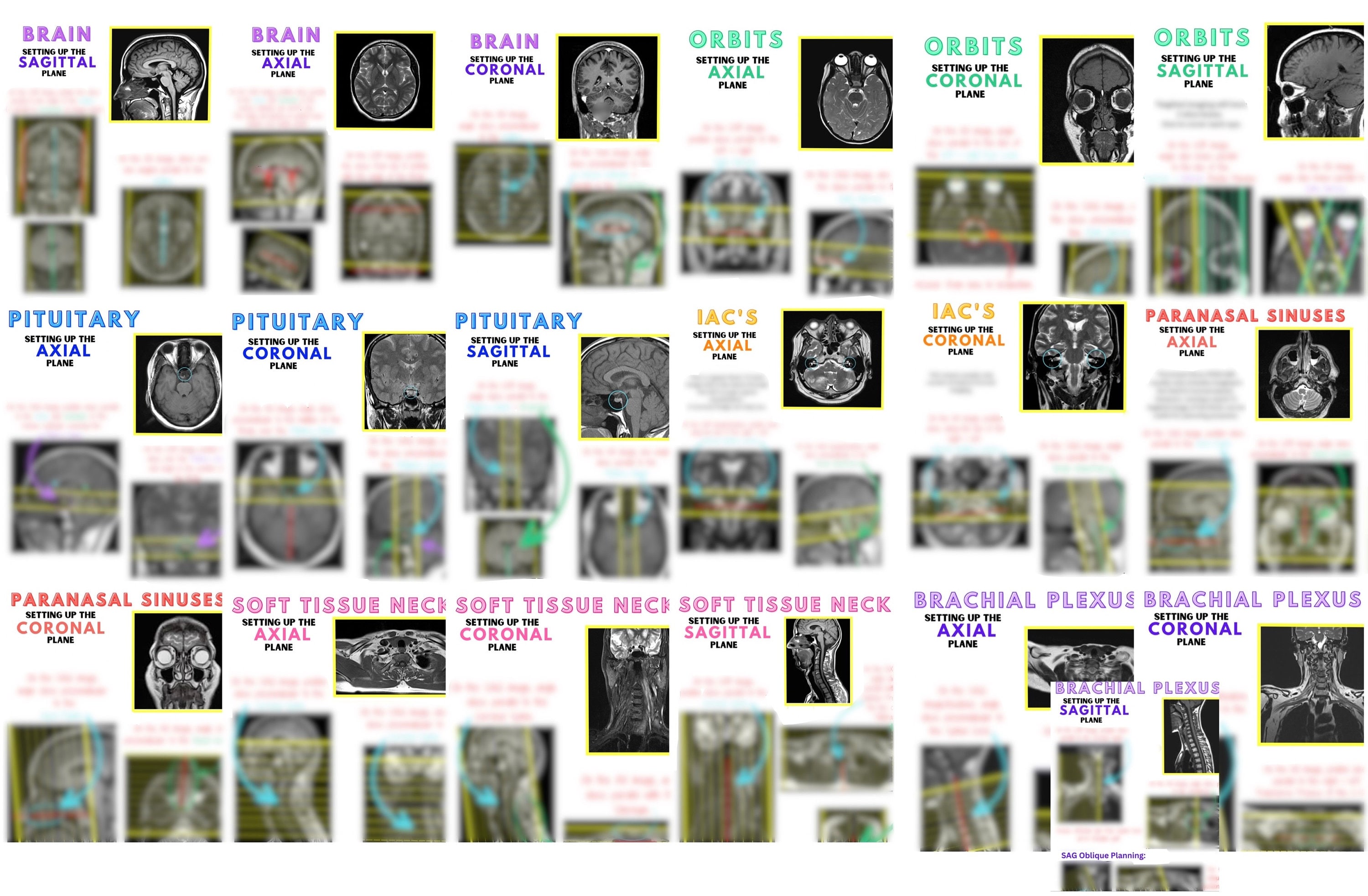 MRI Planning, MRI Positioning, Mri Neuro, Mri Study Guide, Mri Notes ...