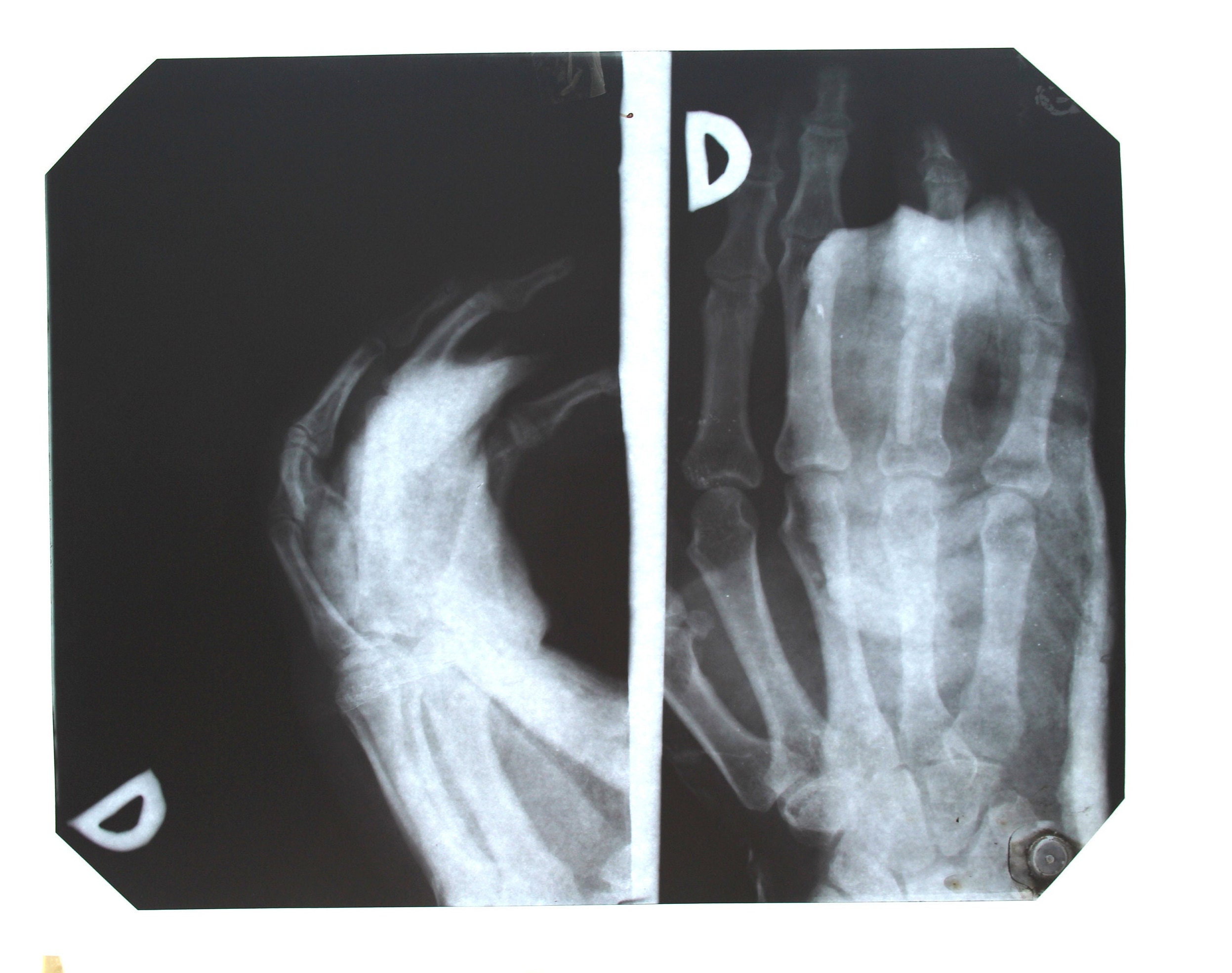 Real Human X-ray , X-ray of a Hand, Vintage X-ray - Etsy