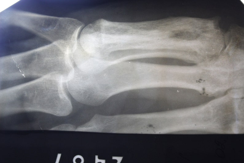 Real X-ray of a Human, X-ray of a Human Hand, X-ray of Fingers - Etsy