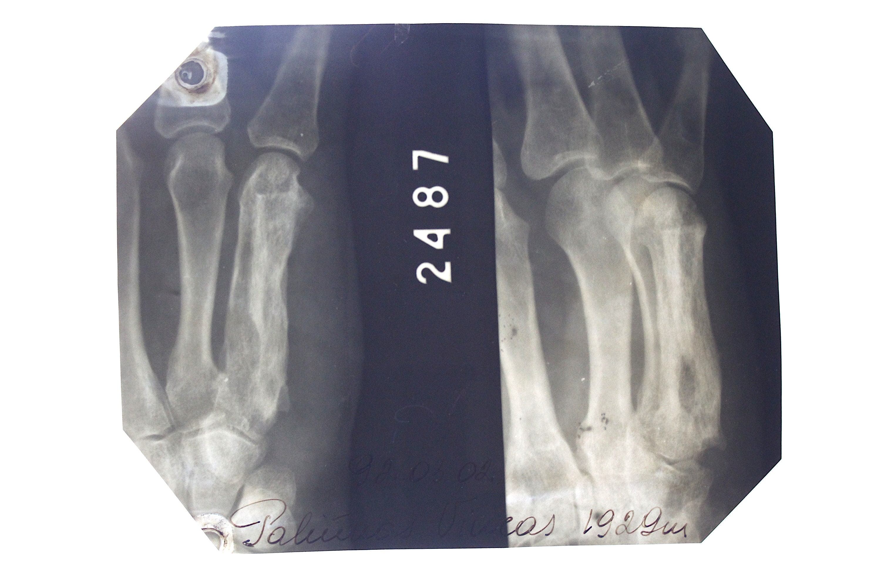 Real X-ray of a Human, X-ray of a Human Hand, X-ray of Fingers - Etsy