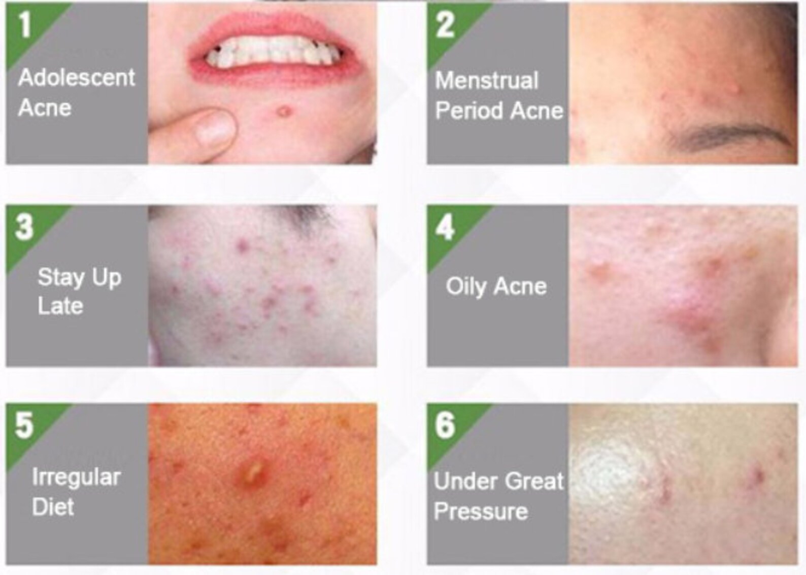 Acne and dot patches for pimple spots | Etsy