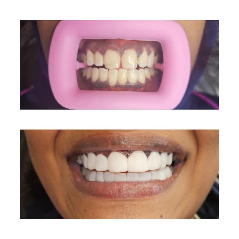 Composite Veneers Step by Step E-book, Steps to Composite Veneers ...