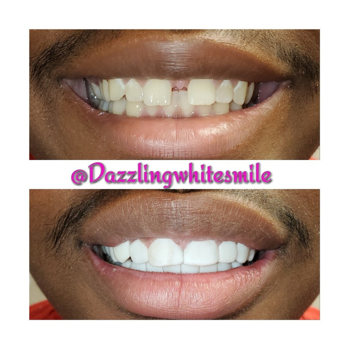 Composite Veneers Step by Step E-book, Steps to Composite Veneers ...