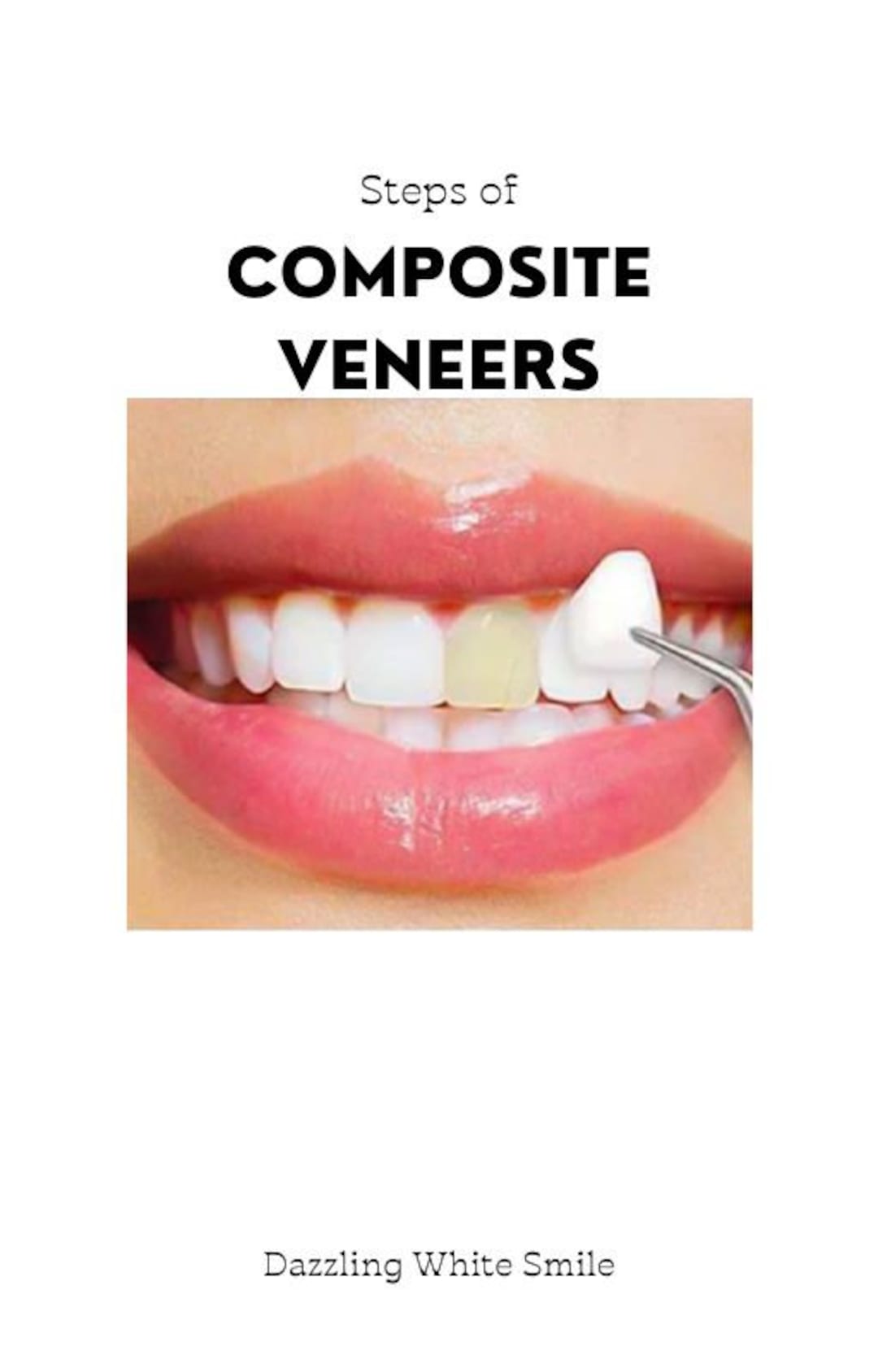 Composite Veneers Step by Step E-book, Steps to Composite Veneers ...