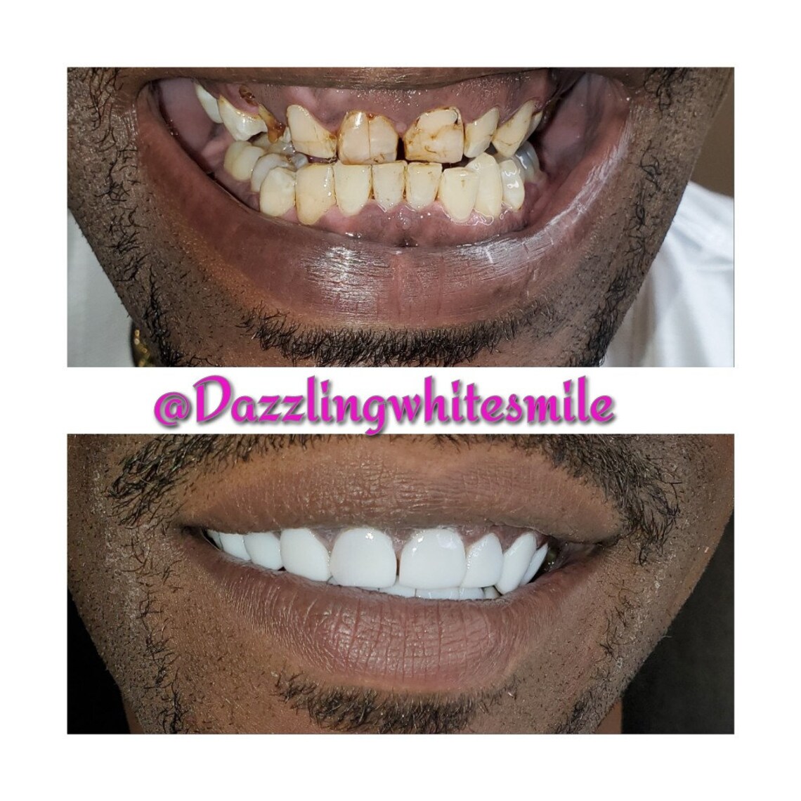 Composite Veneers Step by Step E-book, Steps to Composite Veneers ...