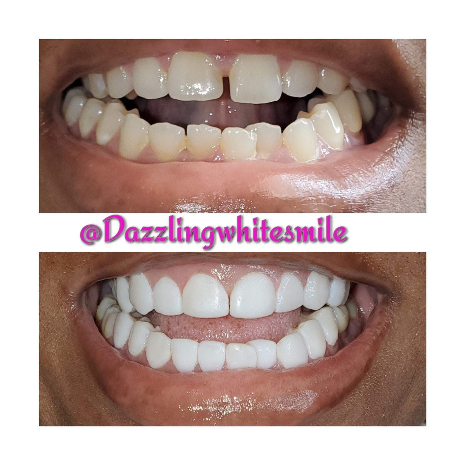 Composite Veneers Step by Step E-book, Steps to Composite Veneers ...