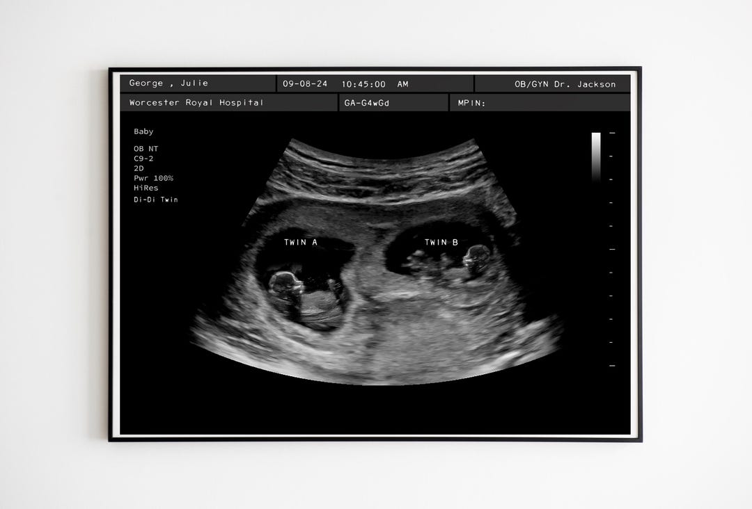Custom Fake Ultrasound Picture Prank, Echography Scans First Baby Scan ...