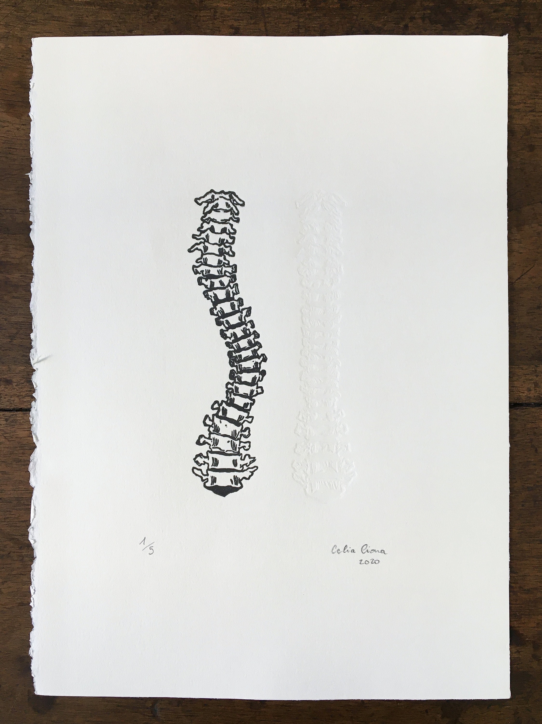 Spine and Scoliosis, Art Print, Limited Edition, Linocut, Handmade ...