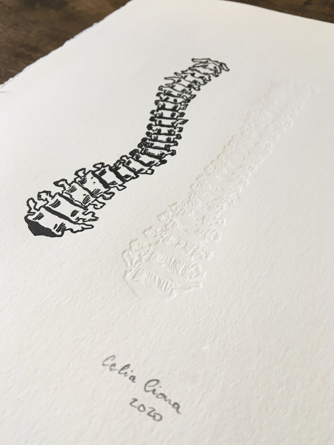Spine and Scoliosis, Art Print, Limited Edition, Linocut, Handmade ...