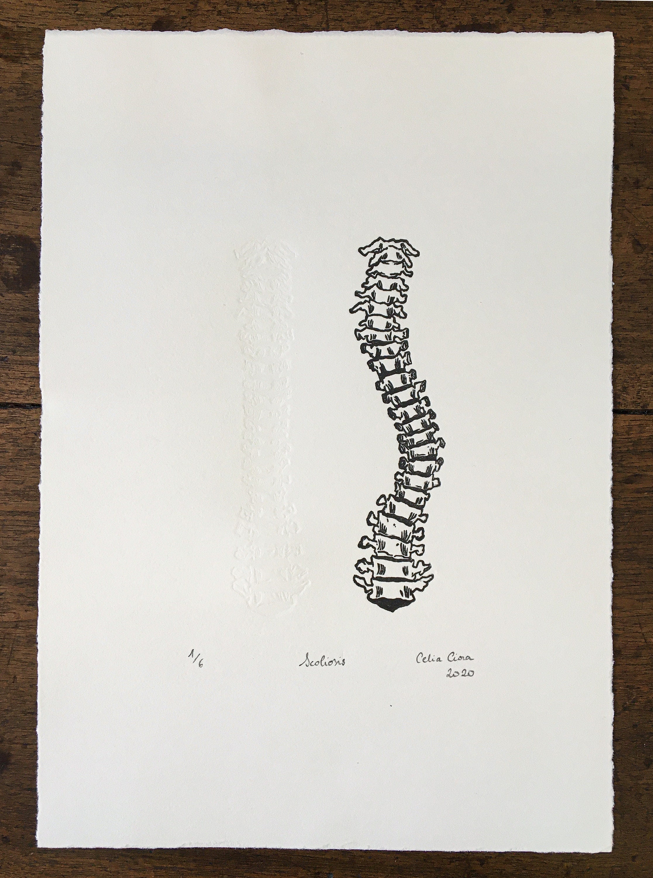 Spine and Scoliosis, Art Print, Limited Edition, Linocut, Handmade ...