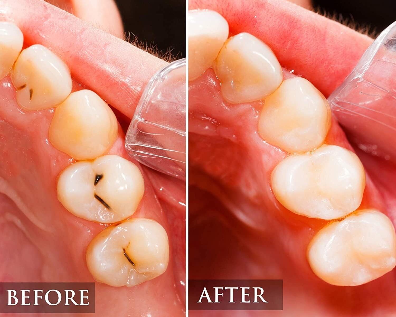 Pack of 2 Dental Tartar Scraper Tool - Detal Hygiene Gift, Dogs Teeth ...