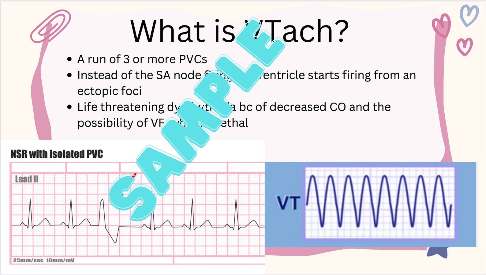 Ventricular Tachycardia Crash Course - Etsy