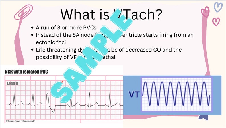 Ventricular Tachycardia Crash Course - Etsy