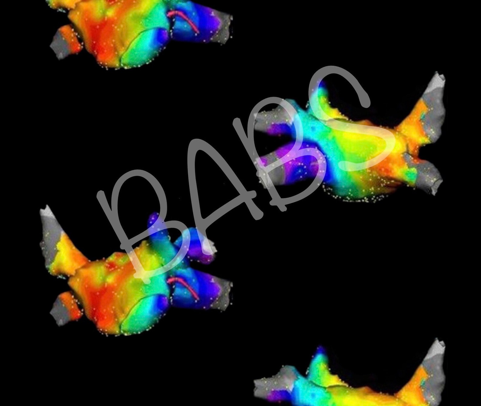 Electrophysiology Mapping Scrub Cap, EP Carto Ablation, Heart Left ...