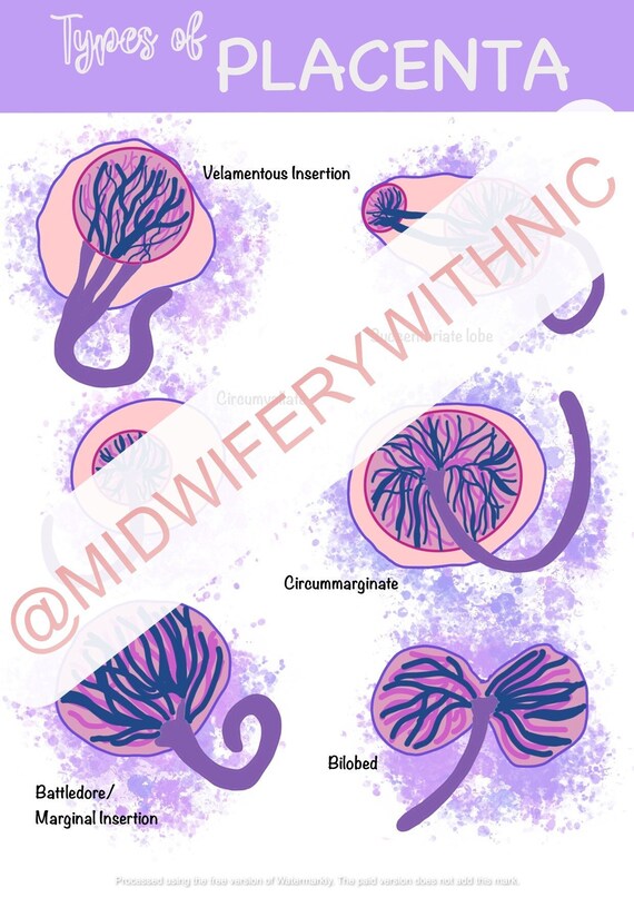 Circummarginate Placenta