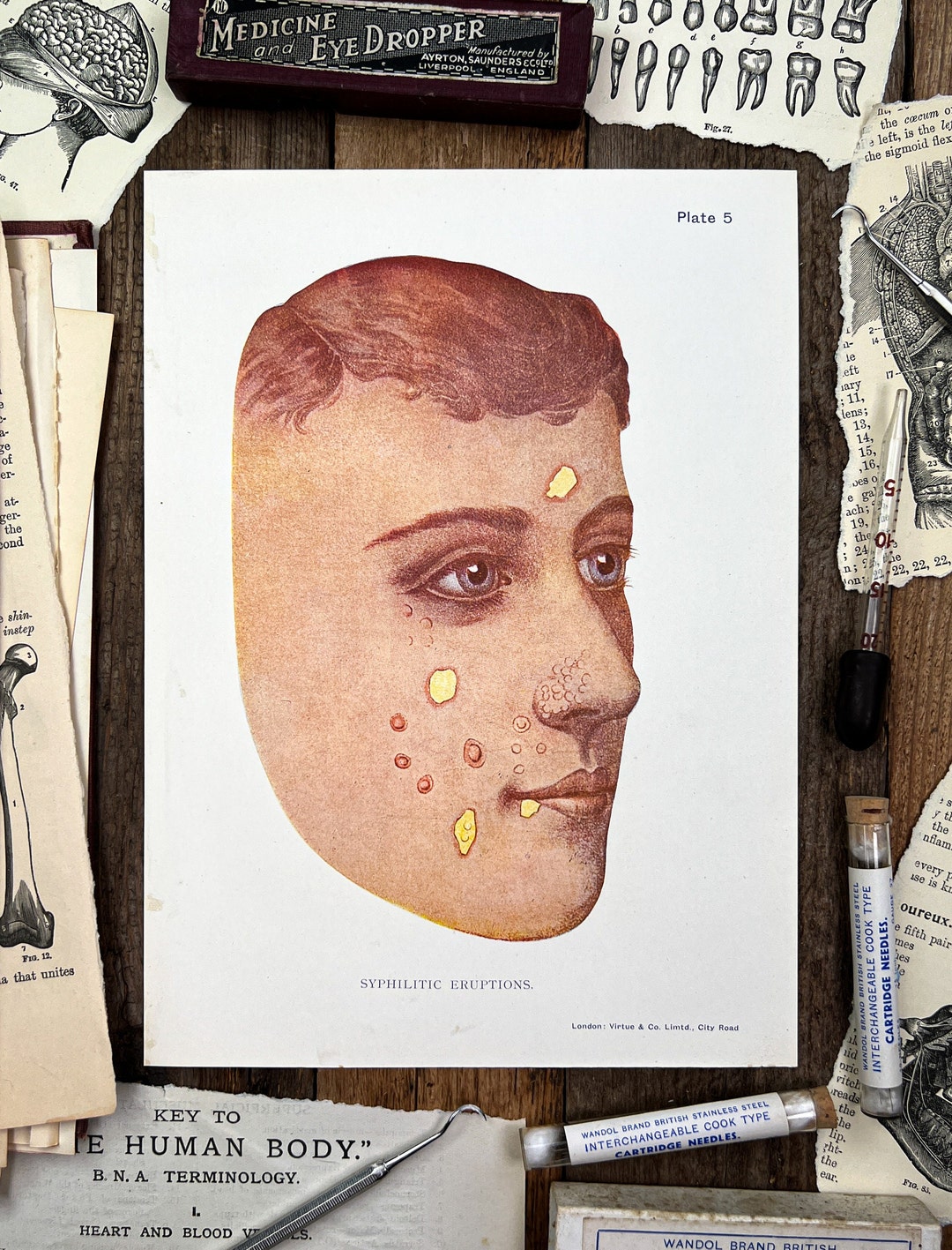 1905 Antique Medical Print Syphilis Infection Weird - Etsy