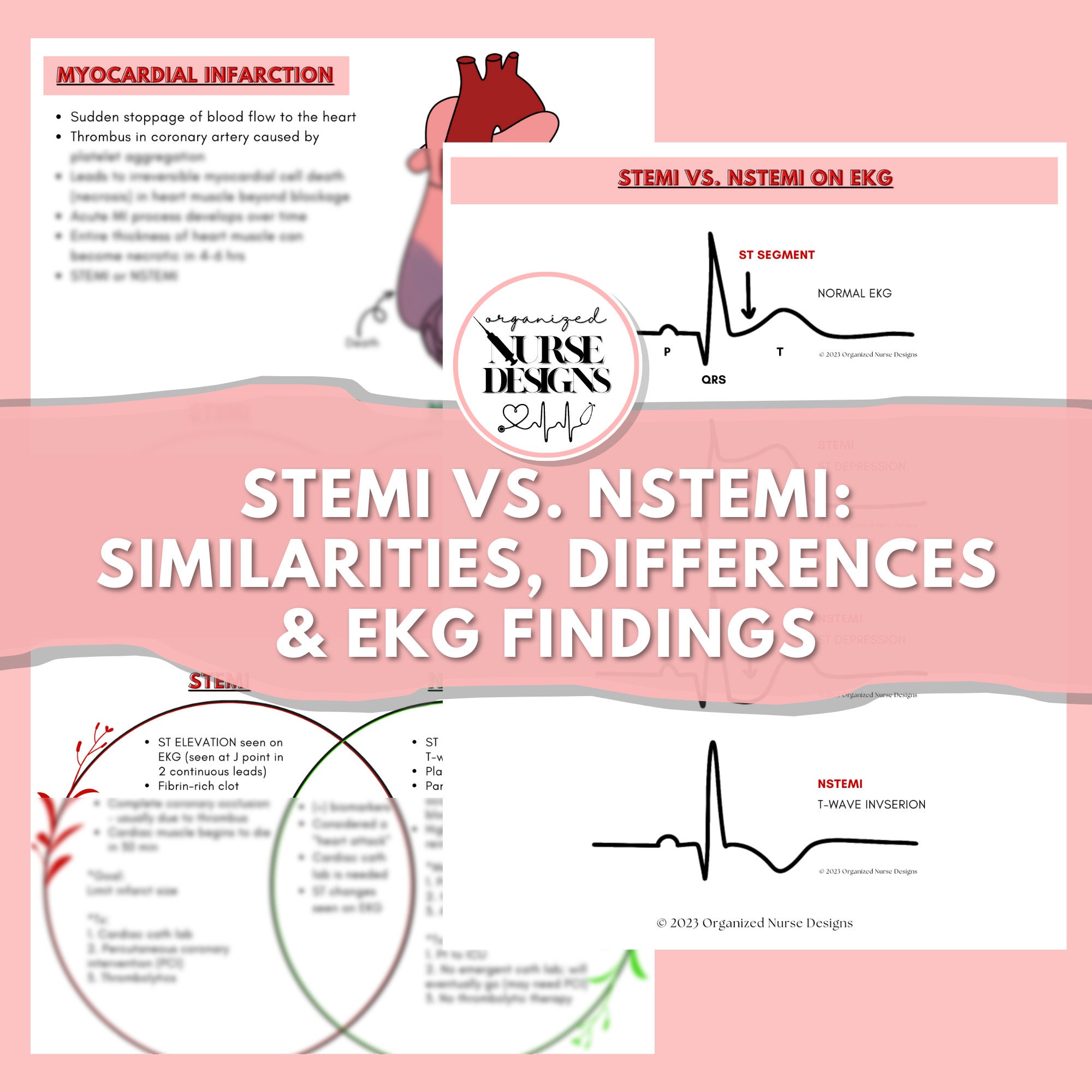 Cardiac Nursing School Study Guide STEMI Vs. NSTEMI | Nursing School ...