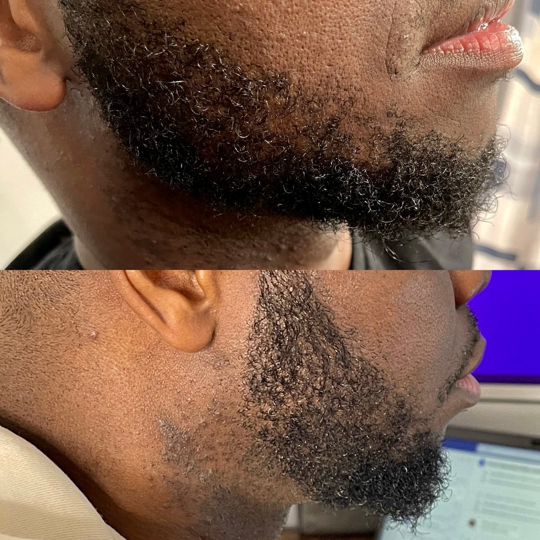 Patchy Beard Growth Oil: Thicken & Fill in Uneven Areas Naturally - Etsy