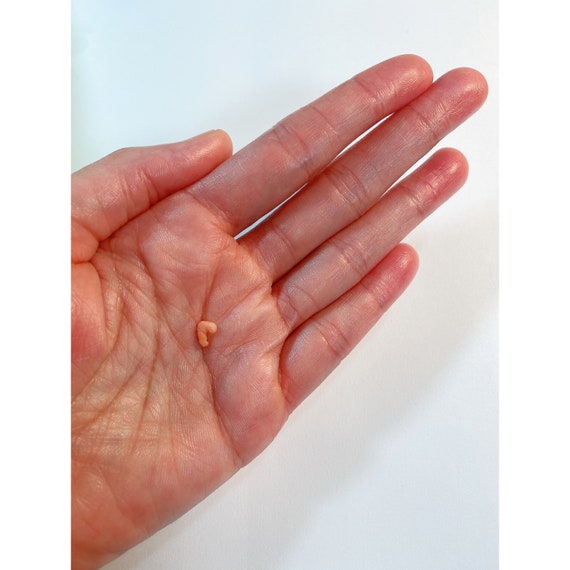 Early Miscarriage 3 Weeks Intrauterine Demise 1st Trimester
