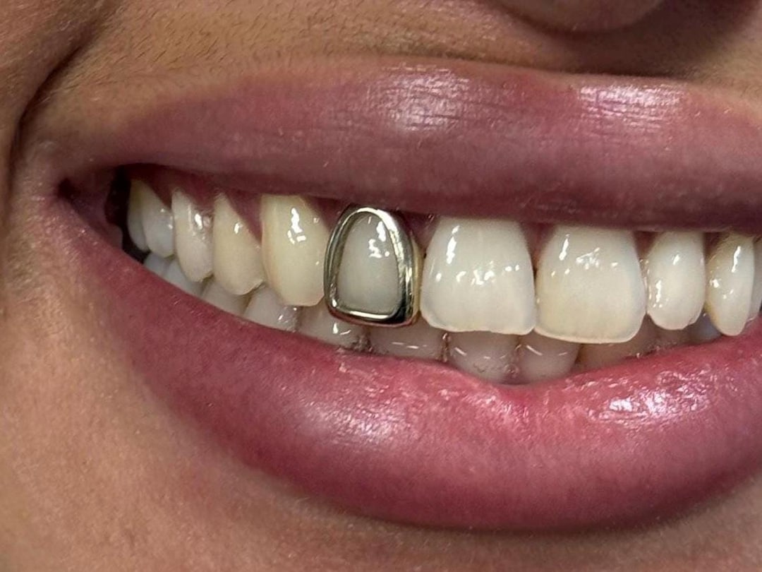 Custom Fitted Gold Window Grillz: Open Face Tooth Cap - Etsy