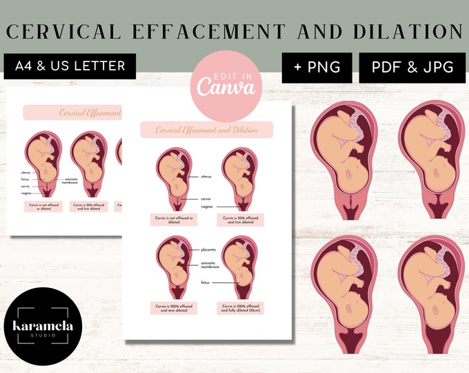 Types of Pelvic Organ Prolapse | Rectocele Stages | Cystocele Stages ...