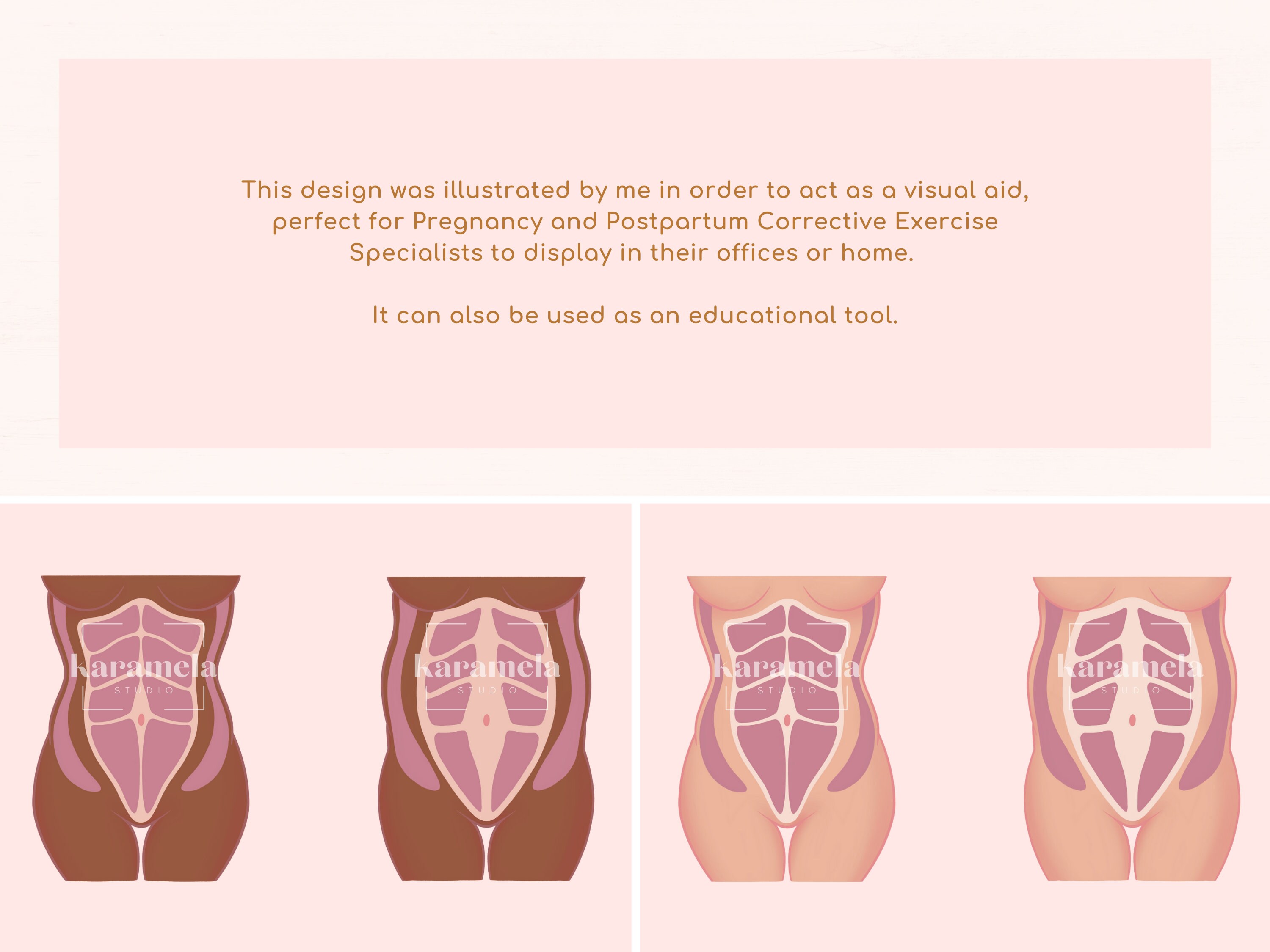 Diastasis Recti Diagram Abdominal Muscles Separation After - Etsy