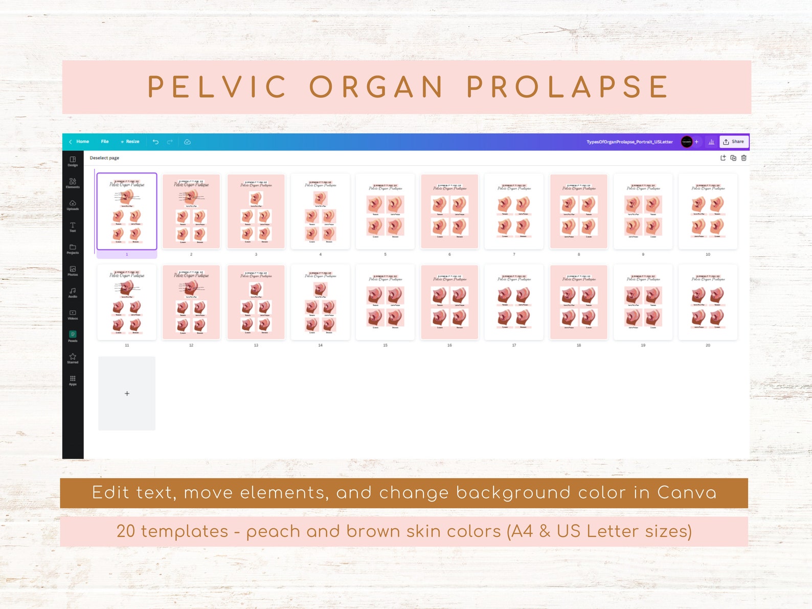 Types of Pelvic Organ Prolapse | Rectocele Stages | Cystocele Stages ...