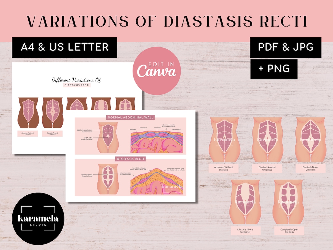 Diastasis Recti Variations Diagram | Abdominal Muscles Separation | Linea Alba | PDF + JPG | PNG ...