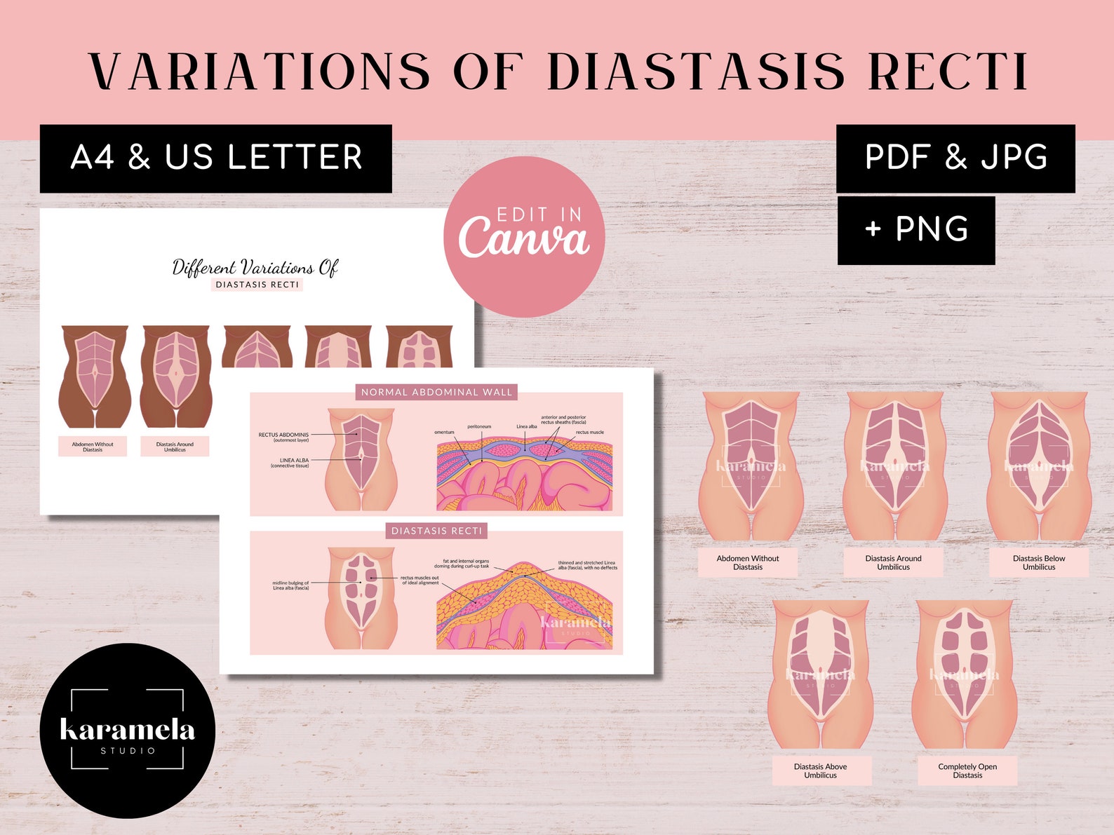 Diastasis Recti Variations Diagram | Abdominal Muscles Separation ...