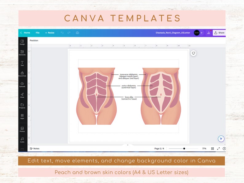 Diastasis Recti Diagram Abdominal Muscles Separation After - Etsy