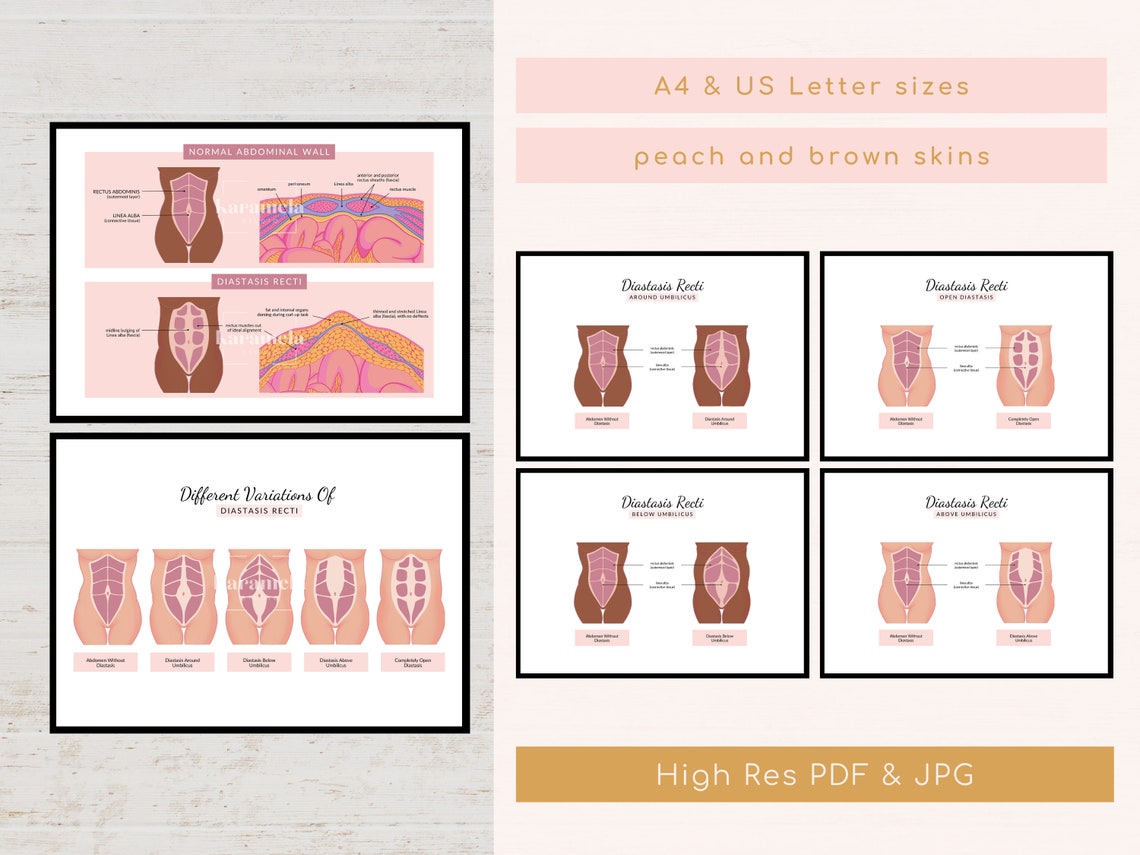 Diastasis Recti Variations Diagram | Abdominal Muscles Separation | Linea Alba | PDF + JPG | PNG ...