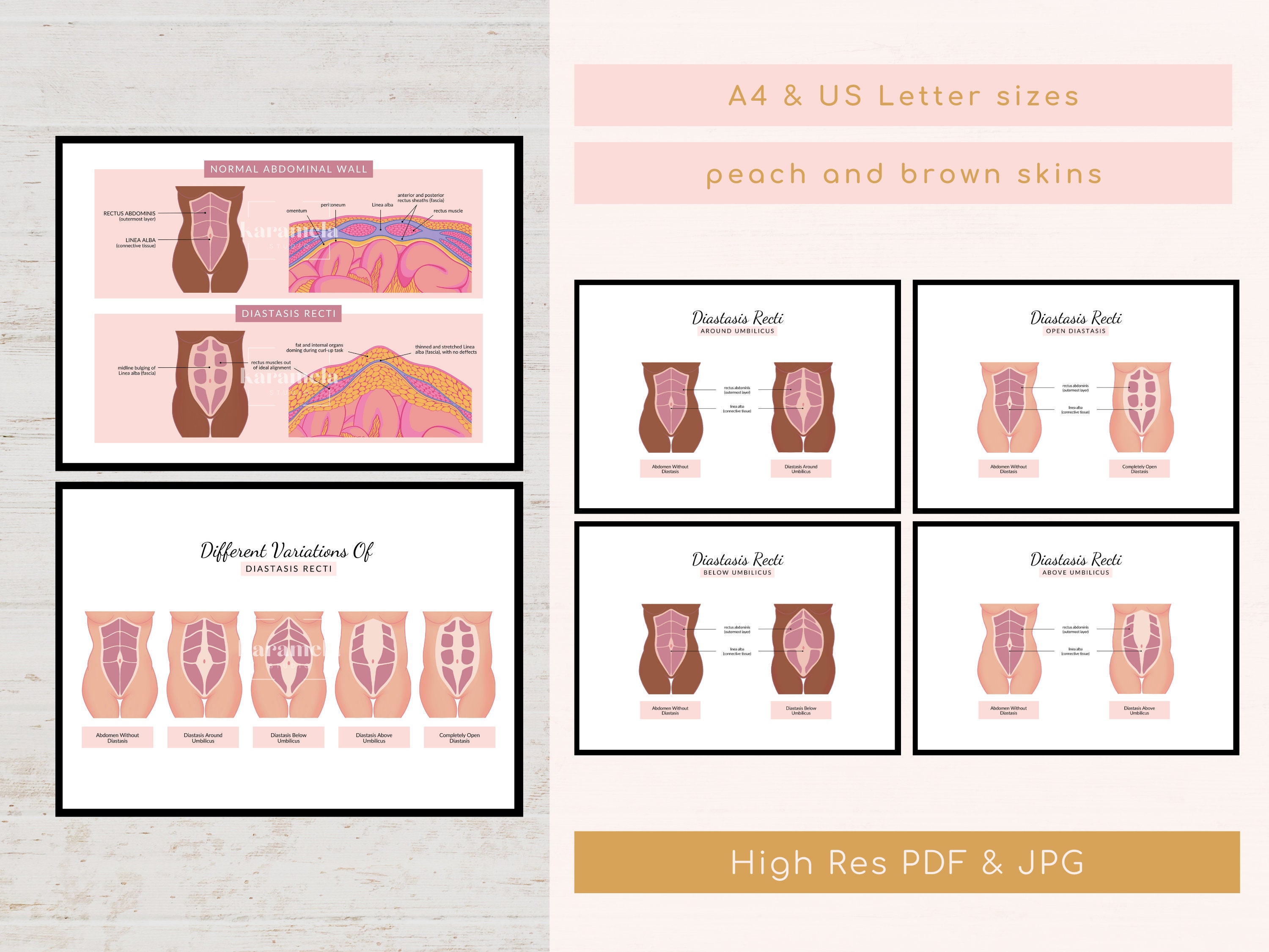 Diastasis Recti Variations Diagram | Abdominal Muscles Separation | Linea Alba | PDF + JPG | PNG ...