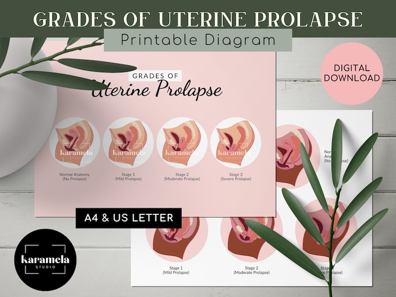 Printable Diagram of Uterine Prolapse Grading Stages of - Etsy Australia