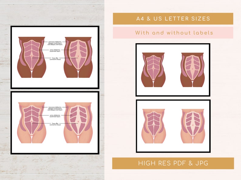 Diastasis Recti Diagram Abdominal Muscles Separation After - Etsy