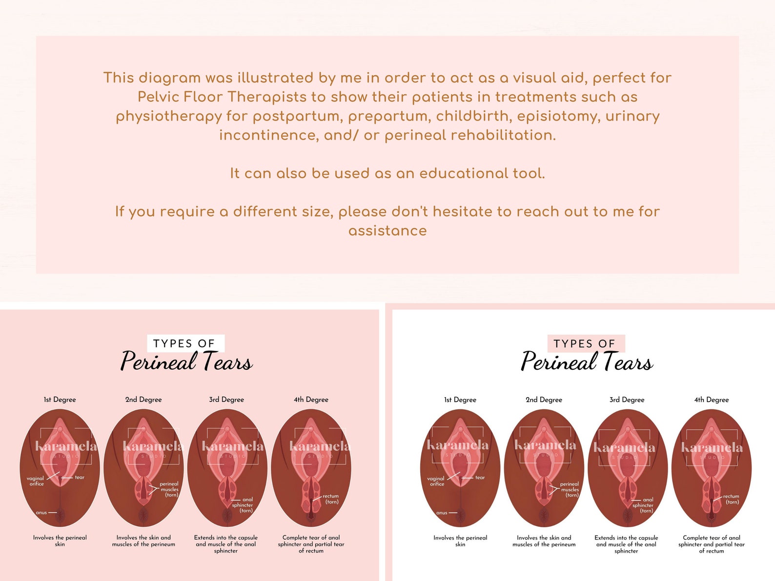Perineal Tears | PNG Images & Canva Templates | PDF + JPG | Episiotomy ...