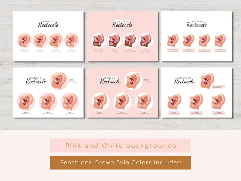 Printable Diagram of Rectocele Grading Stages of Rectocele - Etsy México
