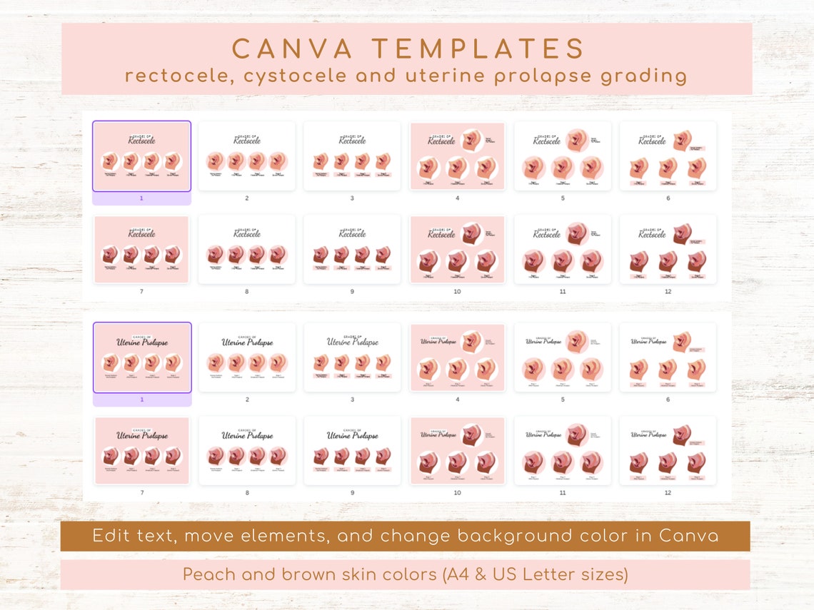 Types of Pelvic Organ Prolapse | Rectocele Stages | Cystocele Stages ...