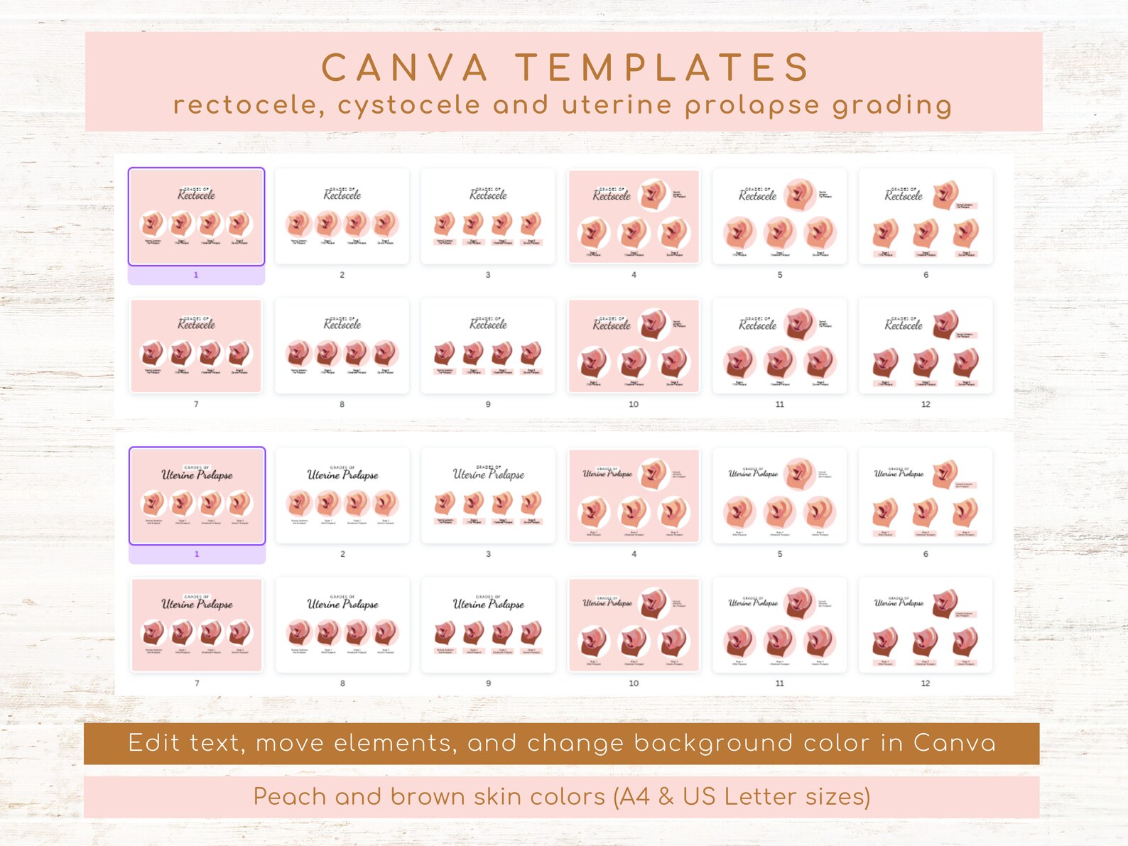 Types of Pelvic Organ Prolapse | Rectocele Stages | Cystocele Stages ...