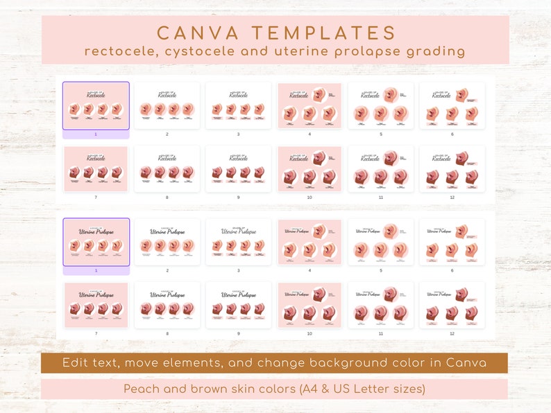 Types of Pelvic Organ Prolapse | Rectocele Stages | Cystocele Stages ...
