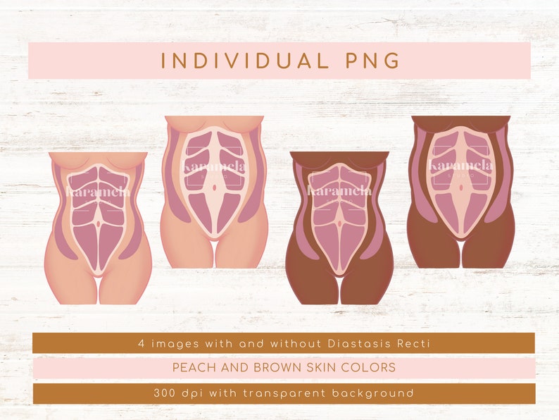 Diastasis Recti Diagram Abdominal Muscles Separation After - Etsy