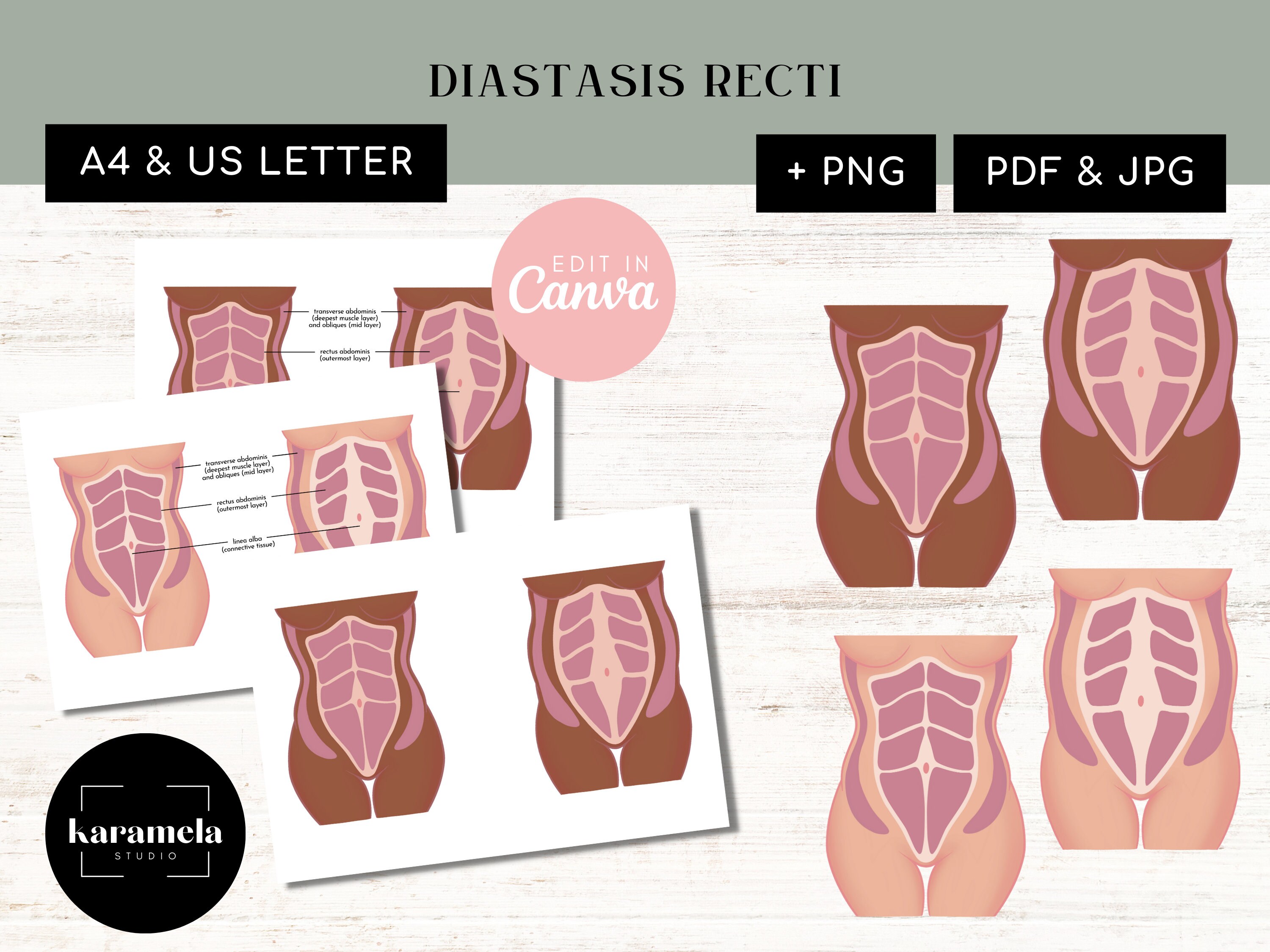 Diastasis Recti Diagram Abdominal Muscles Separation After - Etsy