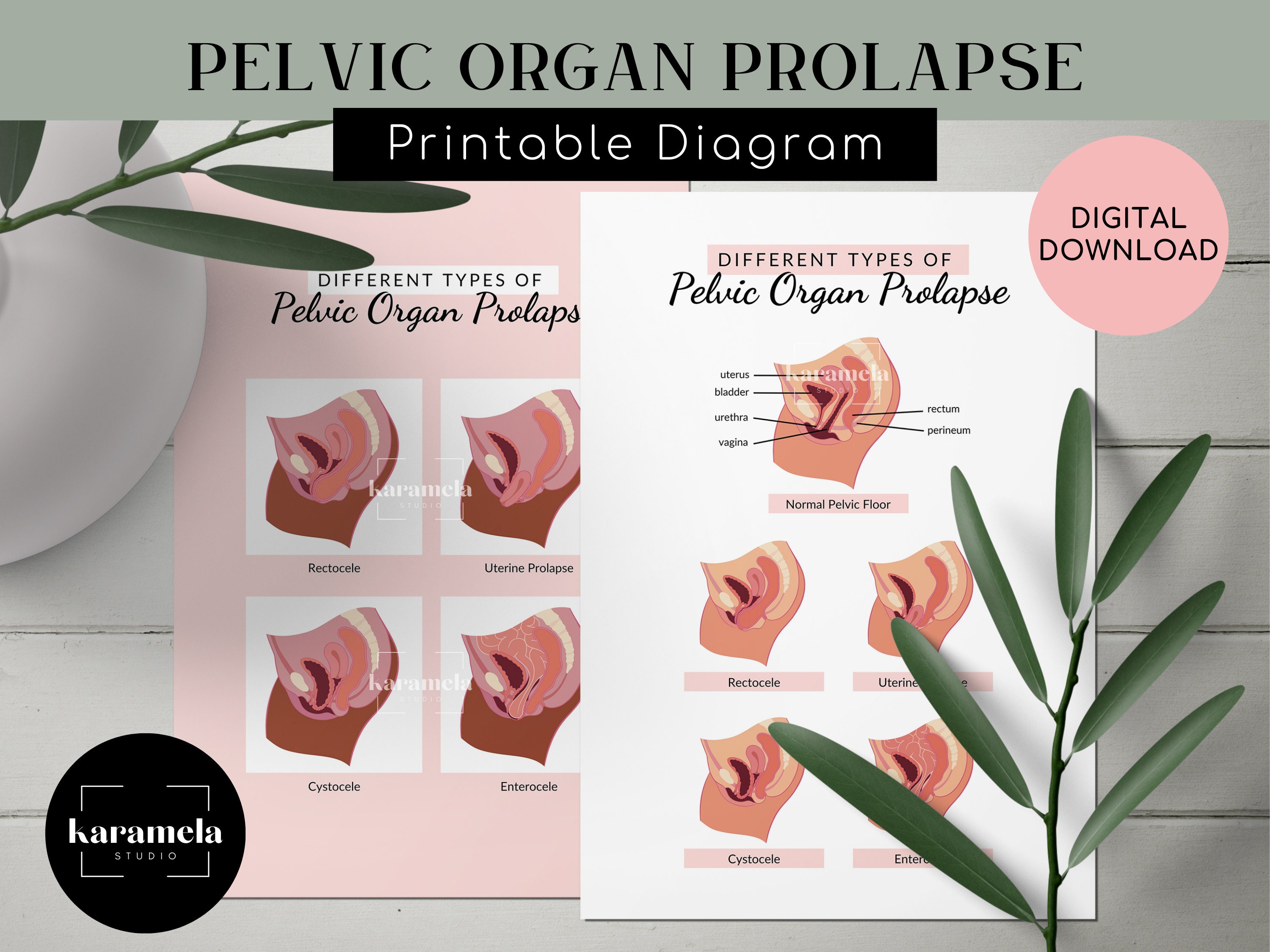 Printable Diagrams of Pelvic Organ Prolapse Pelvic Floor - Etsy UK