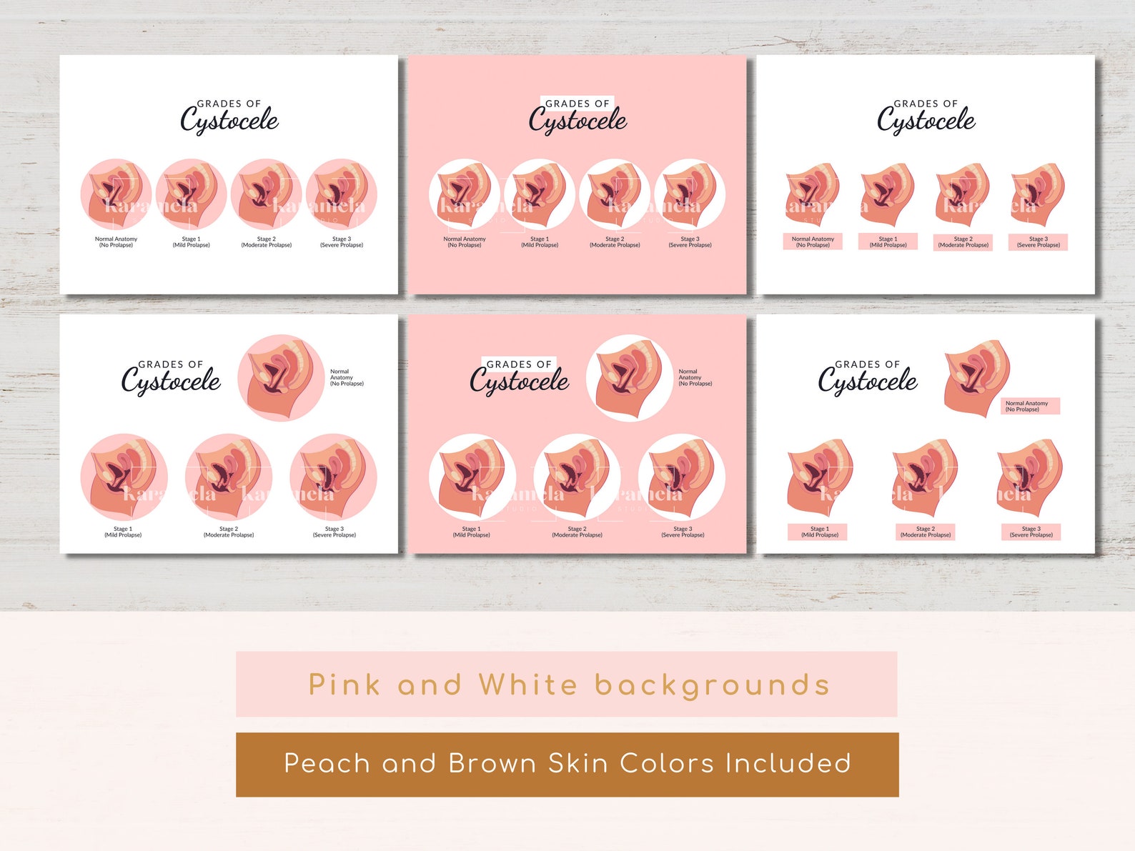 Printable Diagram of Cystocele Grading Stages of Cystocele - Etsy UK