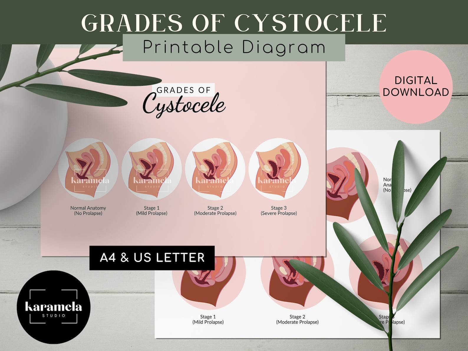 Printable Diagram of Cystocele Grading Stages of Cystocele - Etsy UK