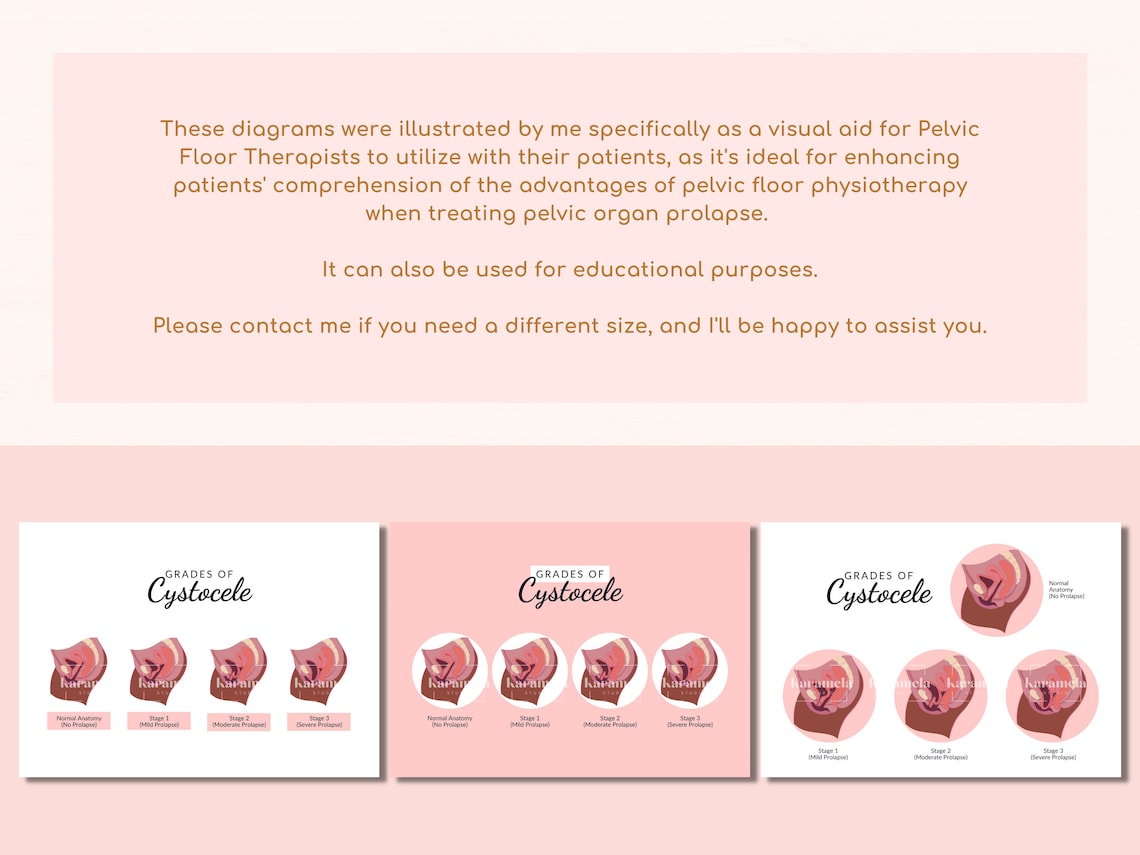 Printable Diagram of Cystocele Grading Stages of Cystocele - Etsy Schweiz