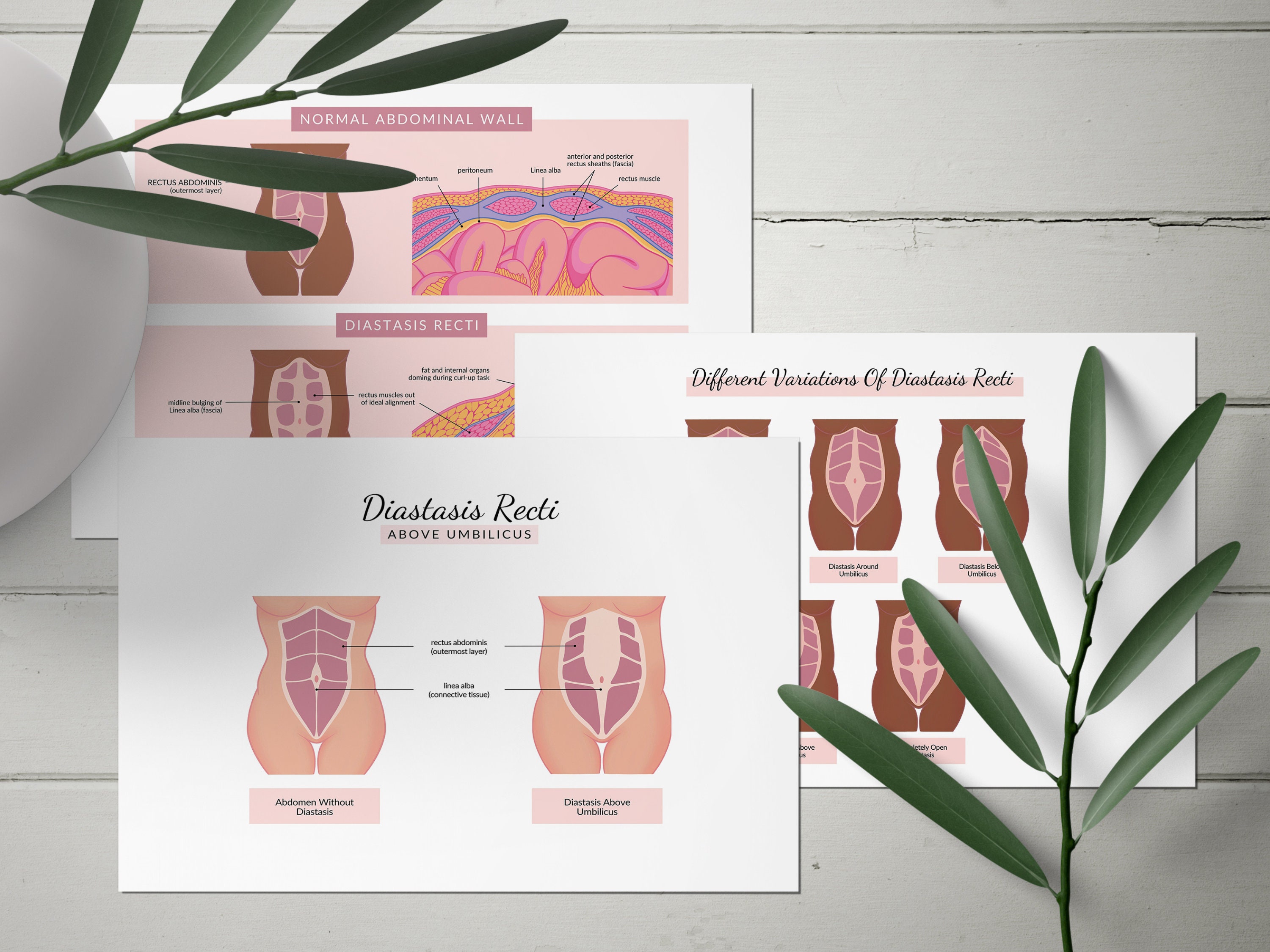 Diastasis Recti Variations Diagram | Abdominal Muscles Separation | Linea Alba | PDF + JPG | PNG ...
