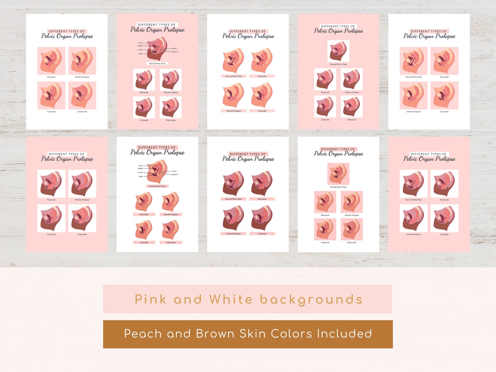 Types of Pelvic Organ Prolapse | Rectocele Stages | Cystocele Stages ...