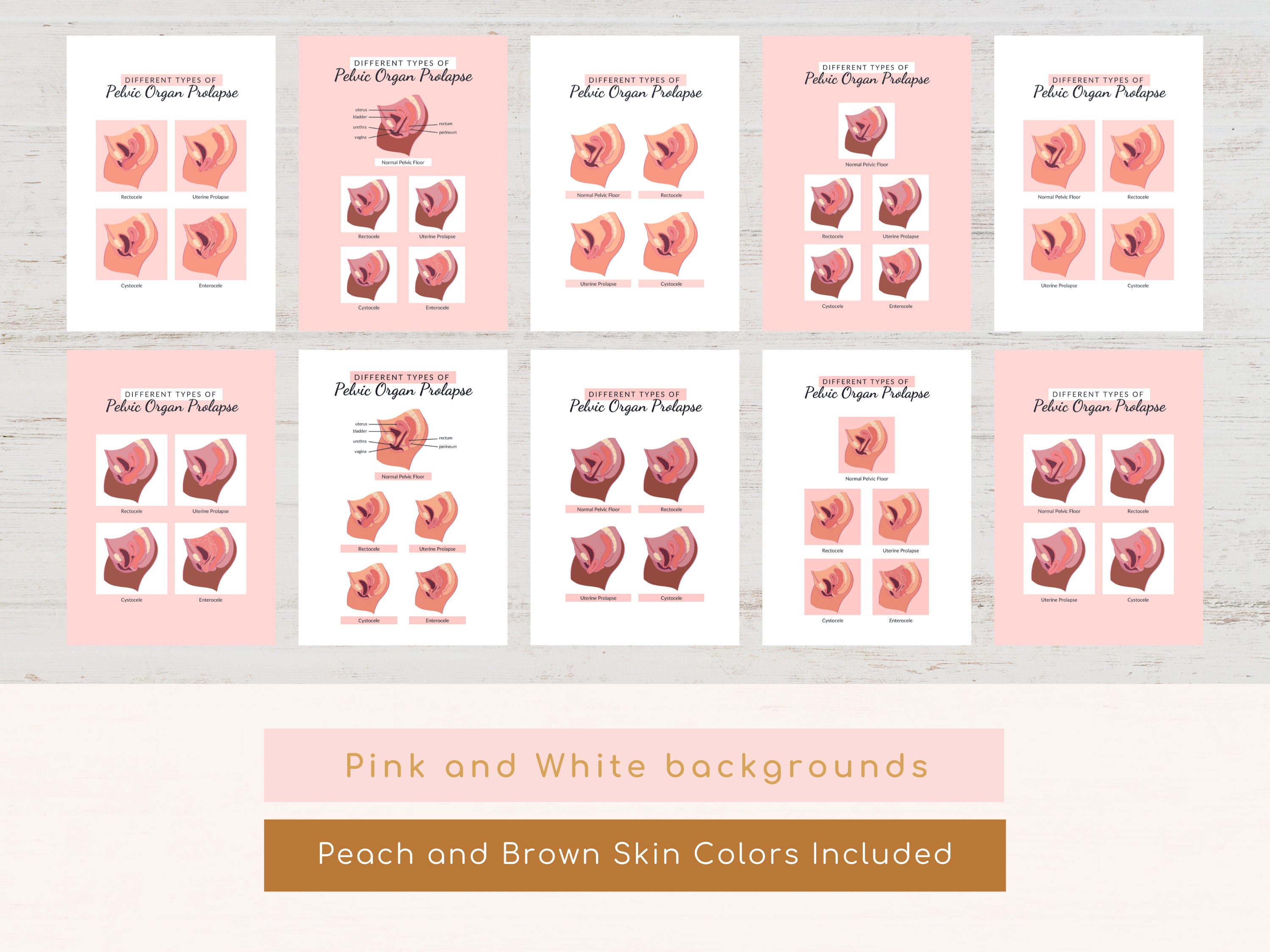 Types of Pelvic Organ Prolapse | Rectocele Stages | Cystocele Stages ...