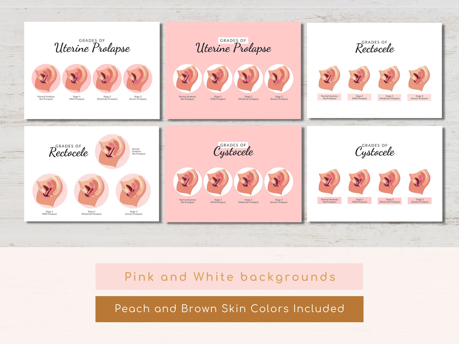 Types of Pelvic Organ Prolapse | Rectocele Stages | Cystocele Stages ...